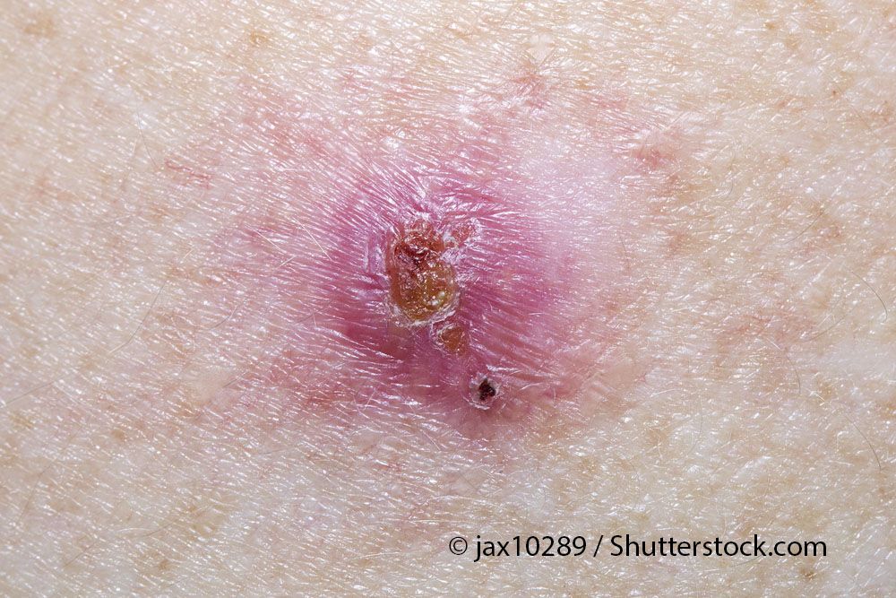 Basal Cell Carcinomas a Clinical Marker for Malignancy Risk?