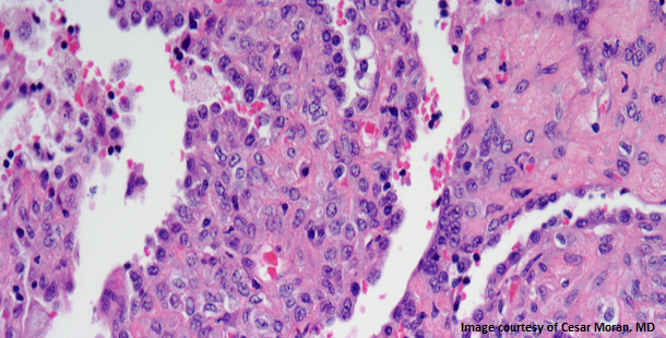 Coin Lesion Found in Lung of 34-Year-Old Woman