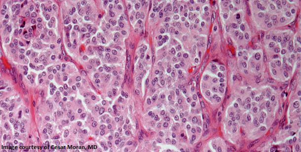 Filum Terminale Mass Found in 43-Year-Old Man