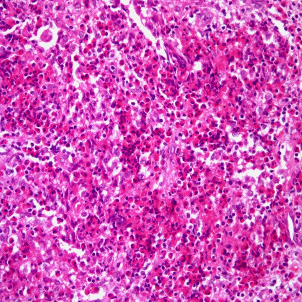 Lump on Clavicle Found on Young Adult