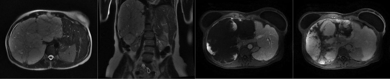 Pain in Right Upper Quadrant of 30-Year-Old Patient