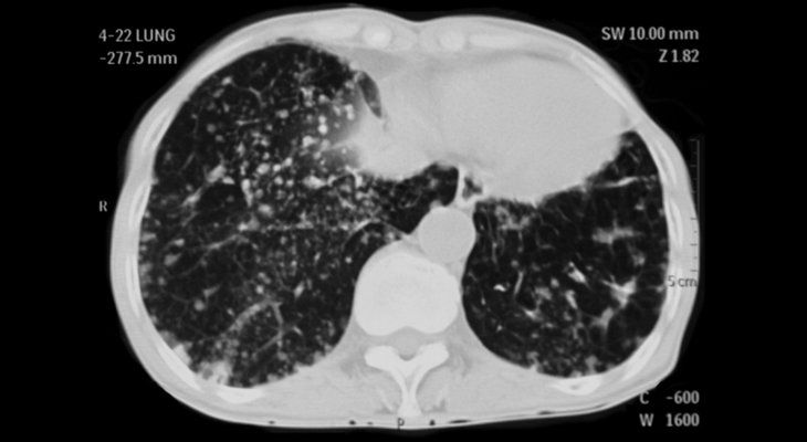 Can CT Lung Screening Improve Smoking Cessation Rates?