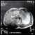 Eovist Injection and Resovist Injection: Two New Liver-Specific ...