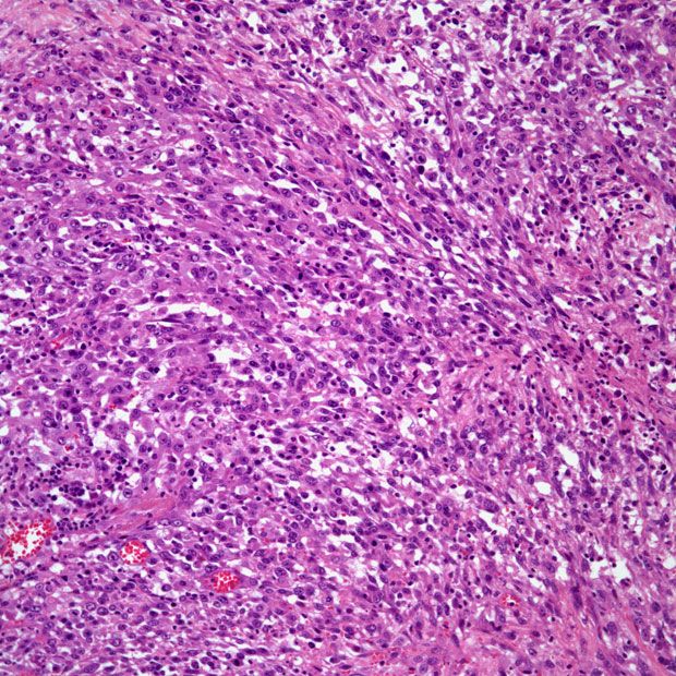 Intrapulmonary Mass Found in 58-Year-Old Patient | CancerNetwork