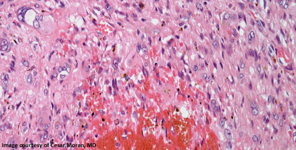 Tibia Lesion Found in 47-Year-Old Man | CancerNetwork