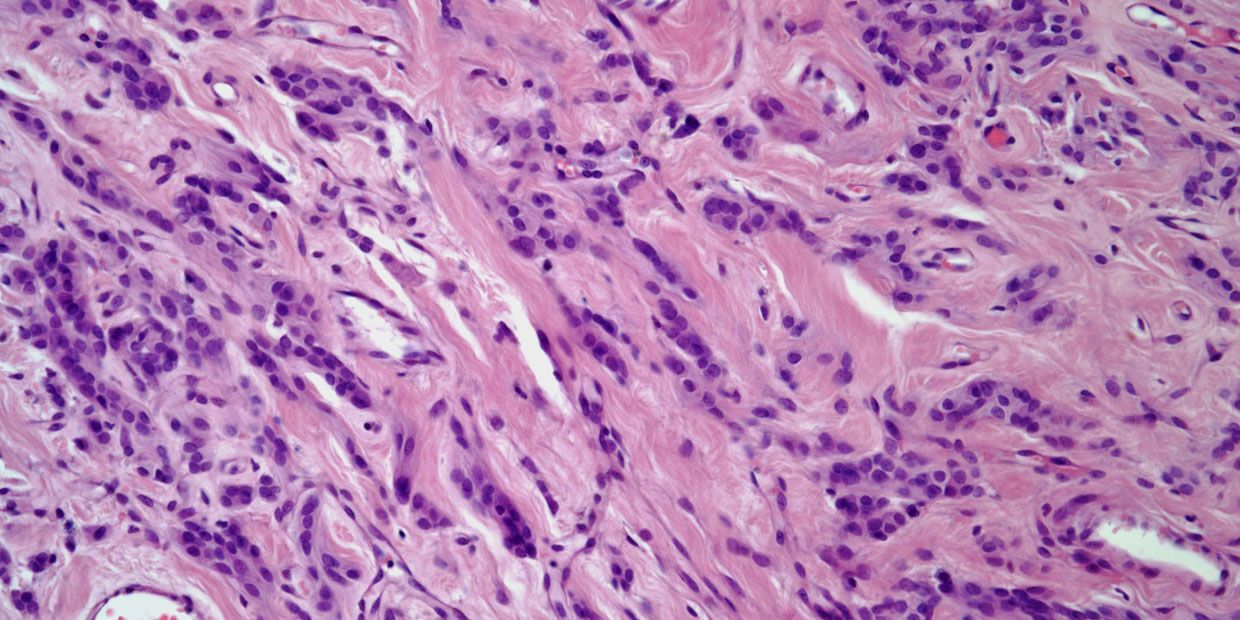 Vulvar Mass in 28-Year-Old Patient | CancerNetwork