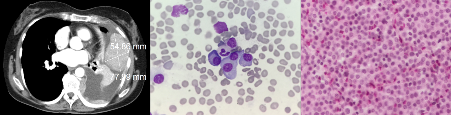 Chest X-Ray Reveals Large Pleural Mass