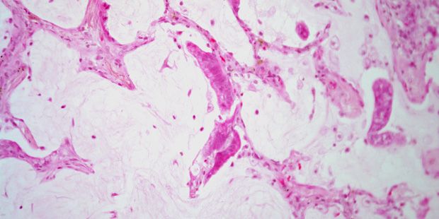 Subpleural Mass in 46-Year-Old Patient
