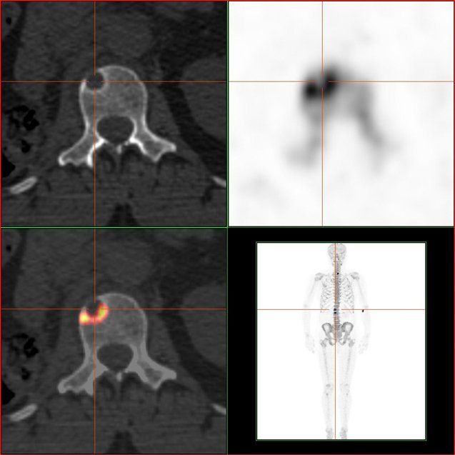 Slide Show: Bone Metastases