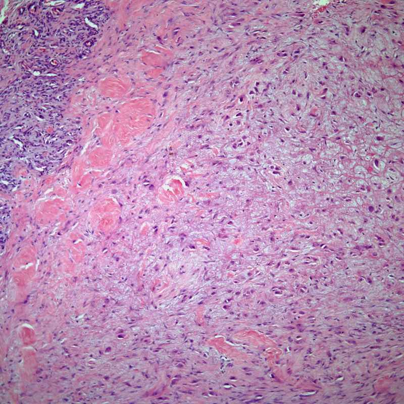 Patient Presents With Skin Nodule on Leg | CancerNetwork