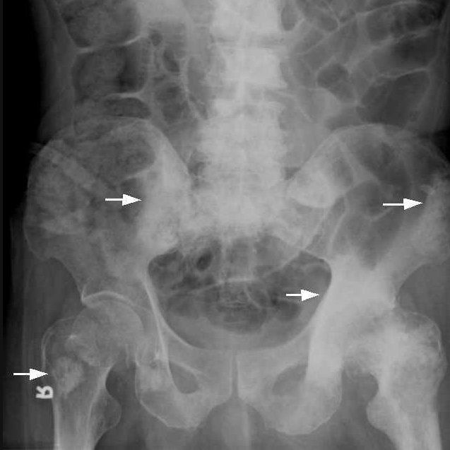 Slide Show: Bone Metastases