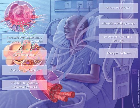 The Evolving Approach to Management of Cancer Cachexia | CancerNetwork