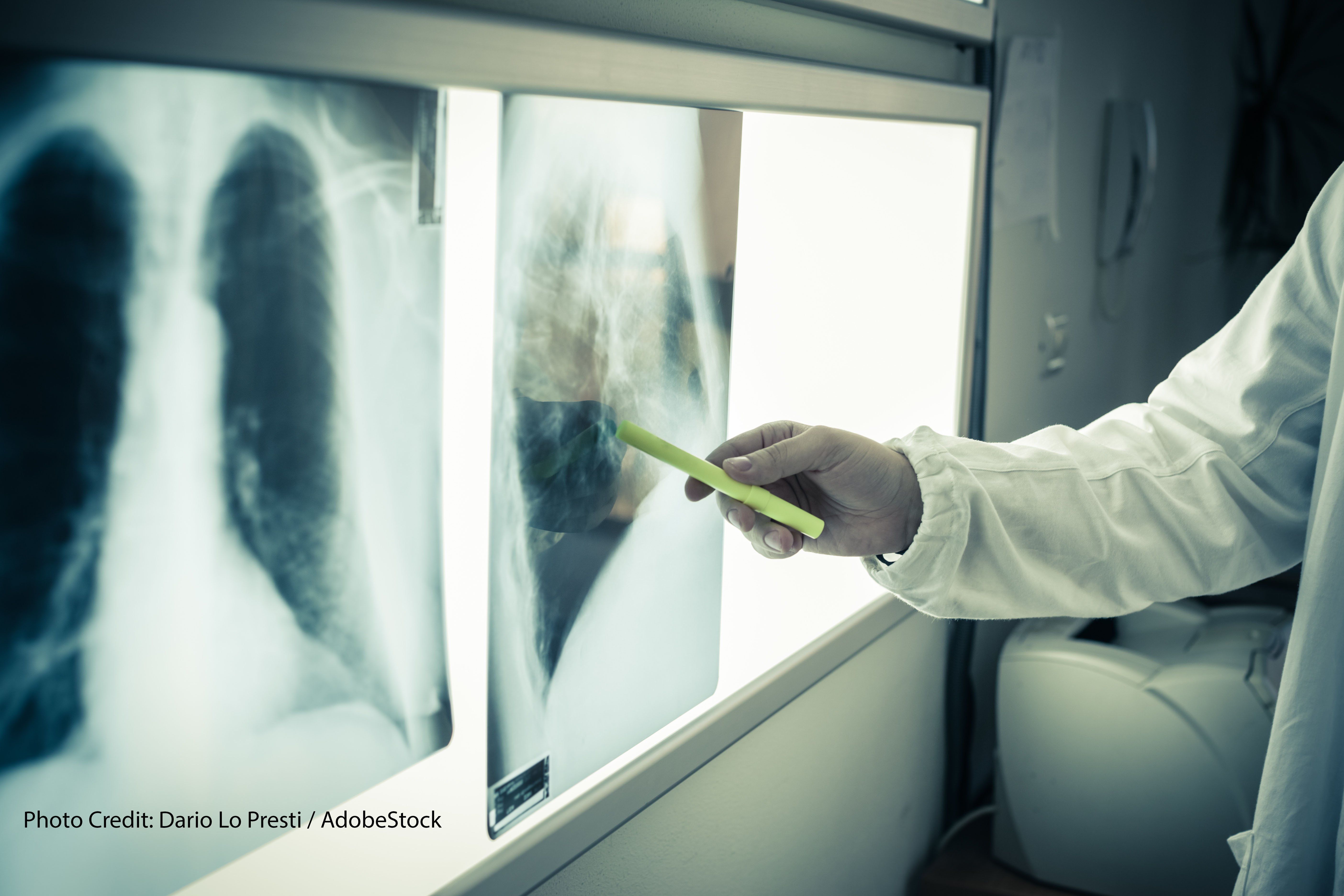 Adjuvant Pemetrexed Plus Cisplatin A Safer Option For Non Squamous Nsclc