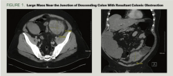 Neoadjuvant FOLFIRINOX Improves Disease Control in Advanced Rectal Cancer