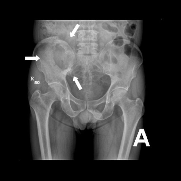 Slide Show: Bone Metastases