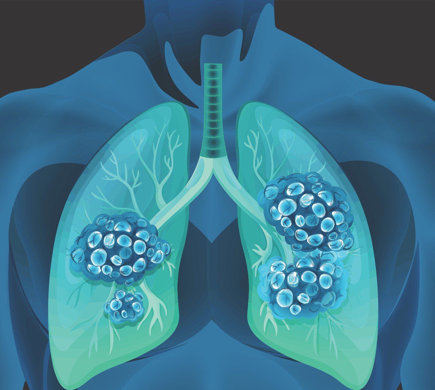 Combination Immunotherapy Efficacy In Lung Cancer May Differ By Patient Sex