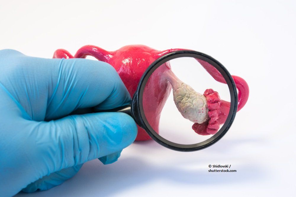 Niraparib Shows “Impressive” Survival Improvements in Advanced Ovarian ...