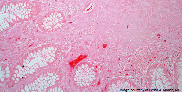 Colon Nodule Found in 52-Year-Old Man