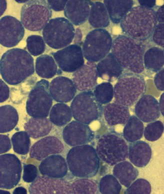 FDA Approves Axatilimab in 9 Mg and 22 Mg Vial Sizes for GVHD ...