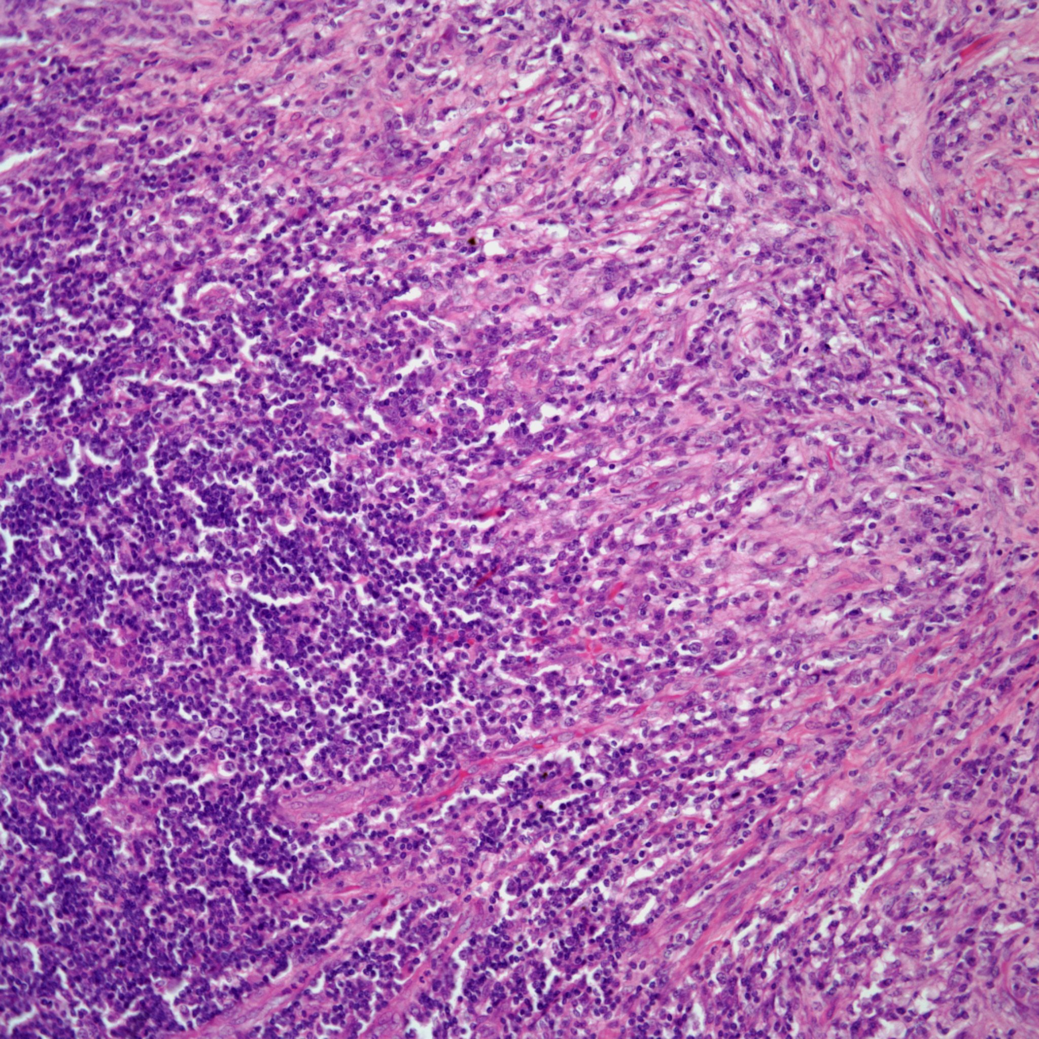 34-Year-Old Man Presents With Axillary Lymphadenopathy