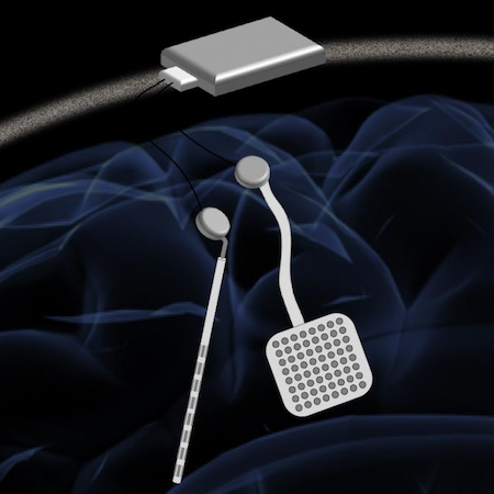 Wireless Neurostimulator Could Offer New Treatment for Parkinson's Disease