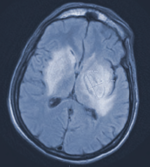 Mixed Fungal Brain Abscess