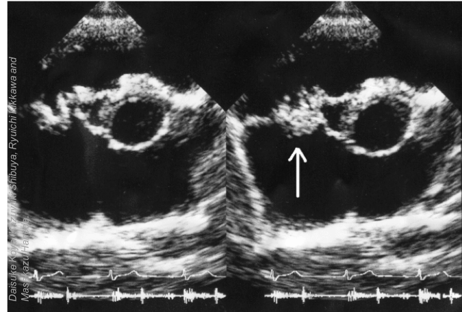 Review: Oral Step Down Therapy Effective for Infective Endocarditis