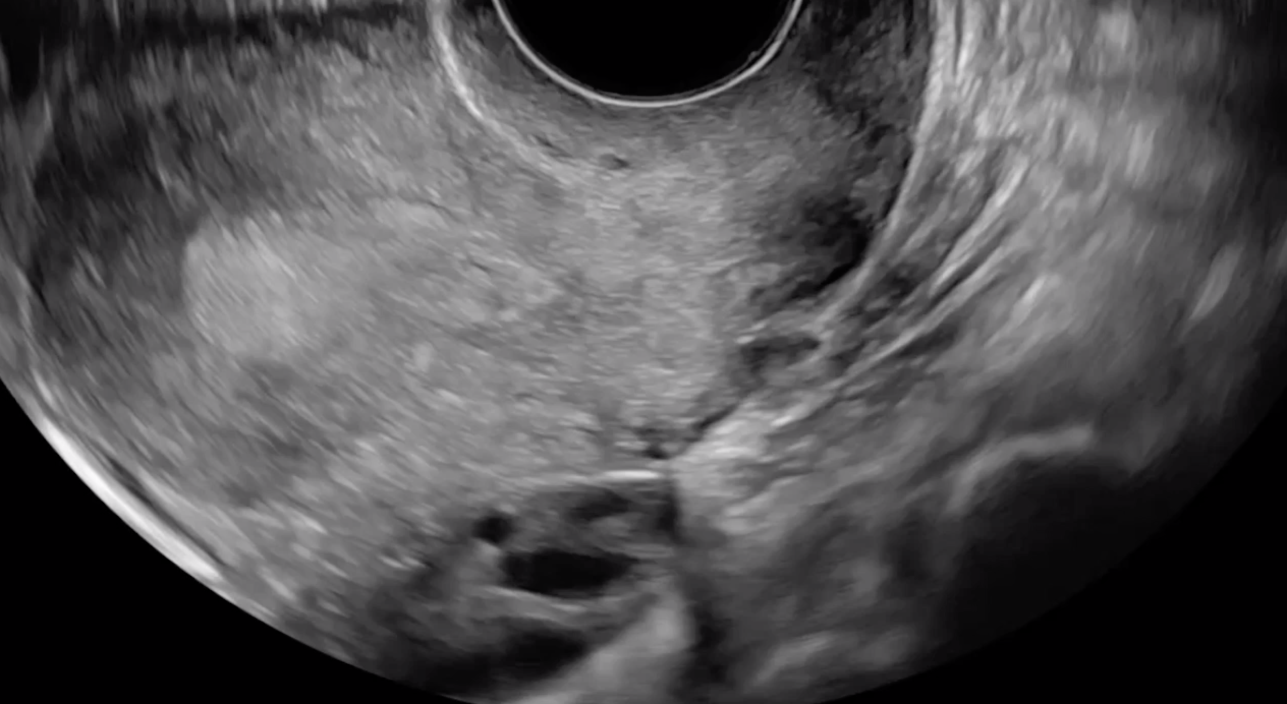 Anteverted uterus, negative sliding sign | Contemporary OB/GYN