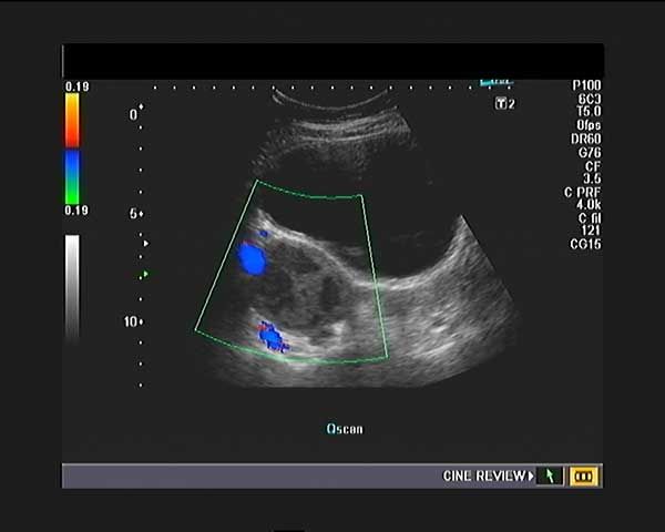 Daily Dx: Right Hemipelvis Pain