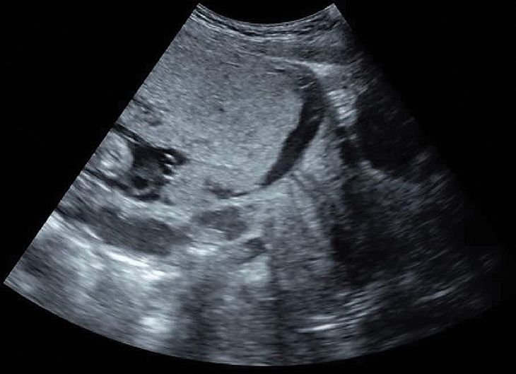 Placenta Previa Practical Approach To Sonographic Evaluation And