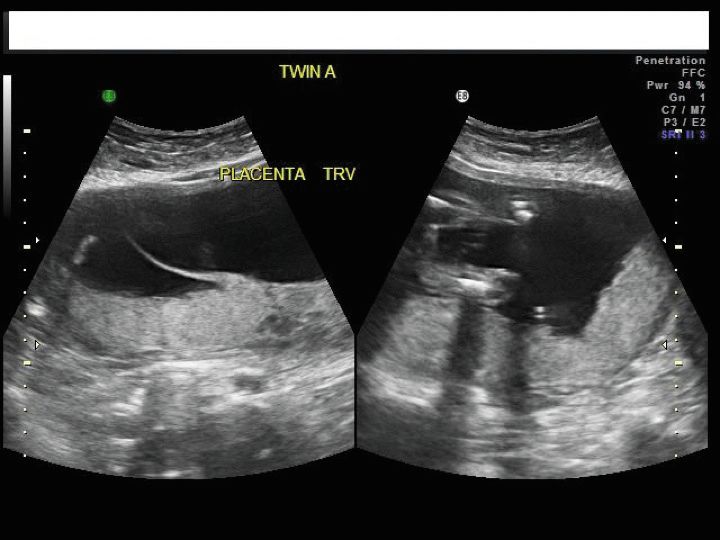 Ultrasound images: Fetal anomalies in multi-fetal gestations