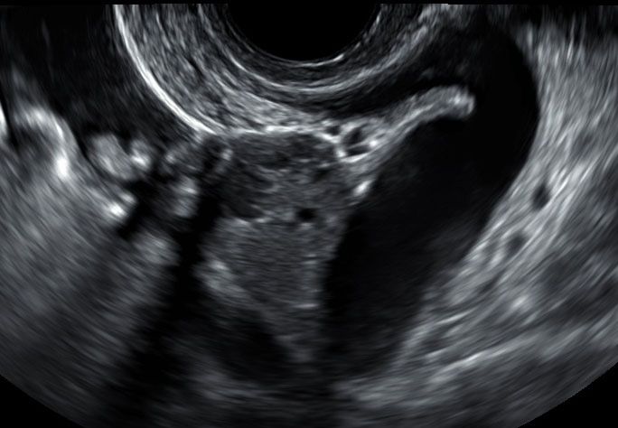 Ultrasound images: Gynecologic diagnoses (Part 2)