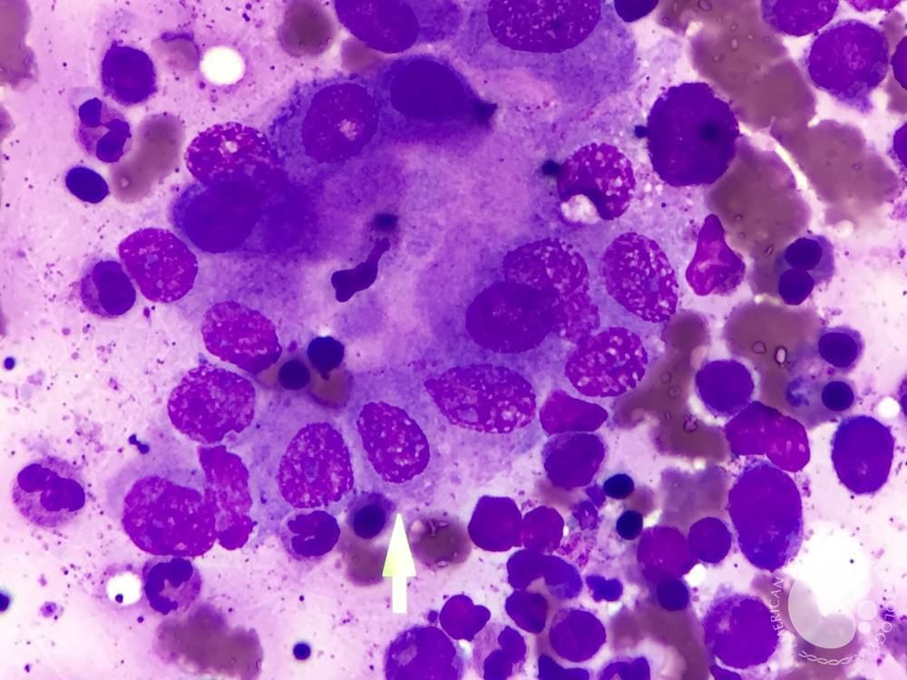 Findings from the LIO-1 Trial in advanced metastatic tumors