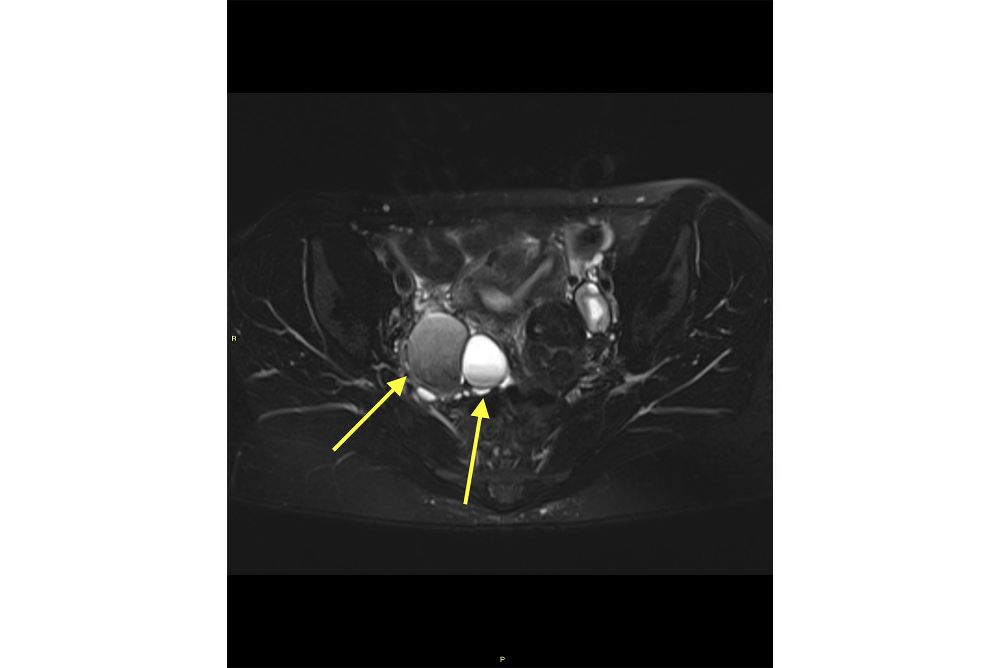 The value of GBCA in MRI images | Contemporary OBGyn