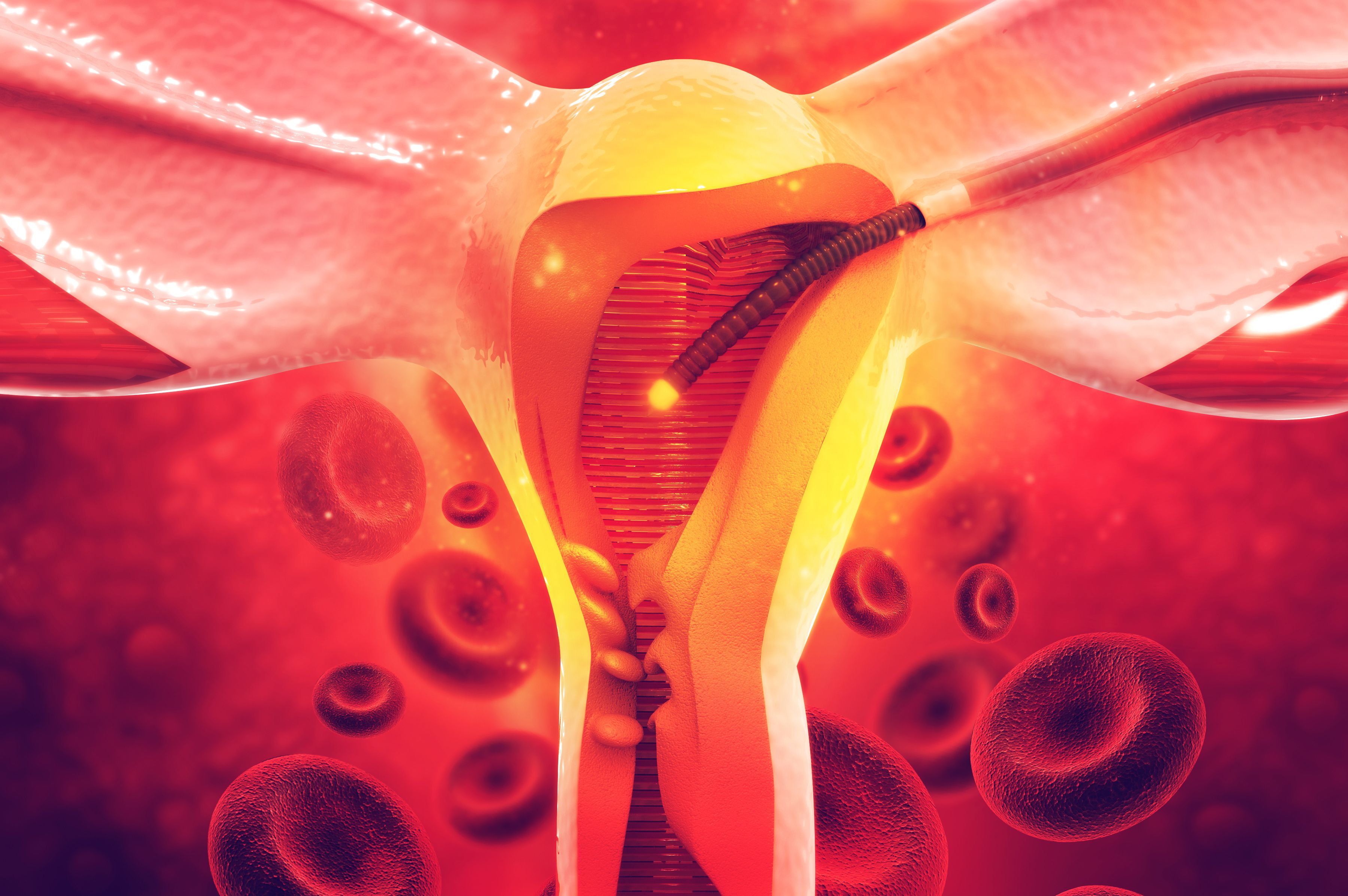 Laparoscopic myomectomy vs. open myomectomy for treating uterine fibroids