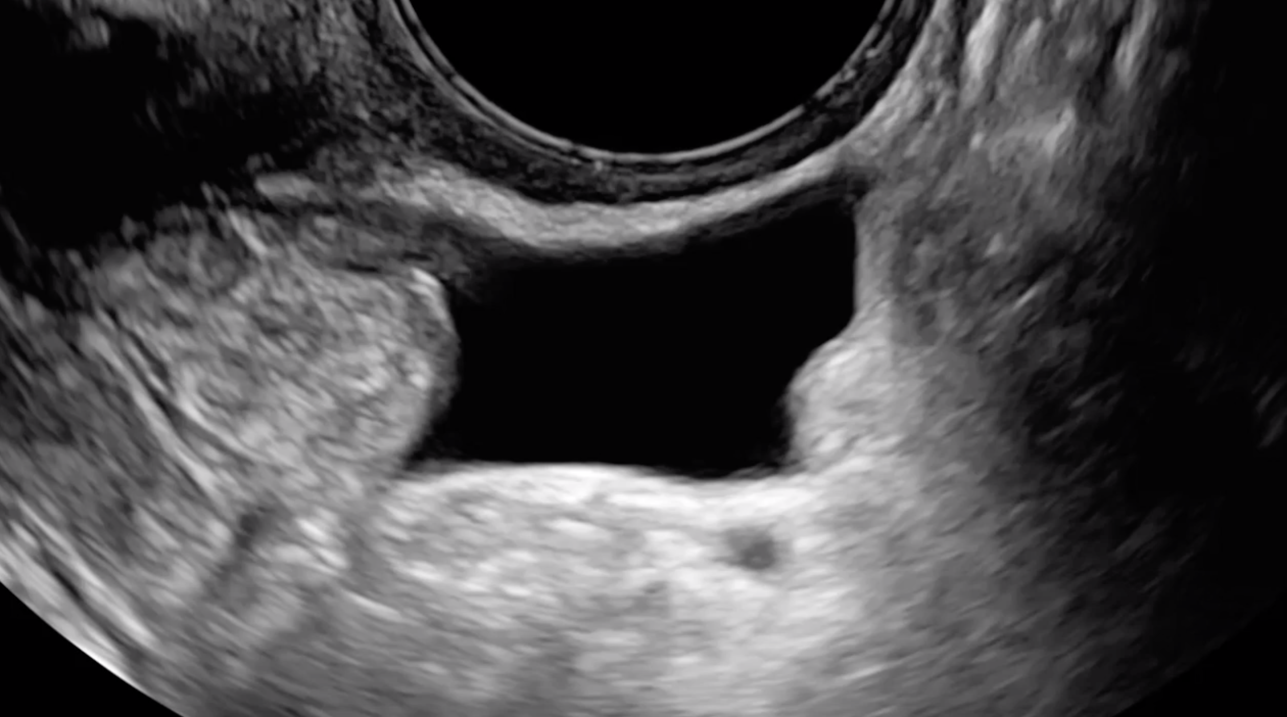 Normal uterosacral ligament and rectouterine pouch peritoneum ...
