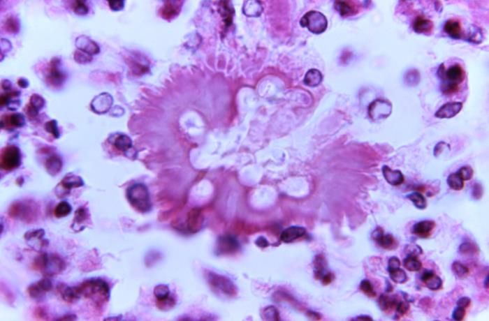 Risk factors for candidiasis