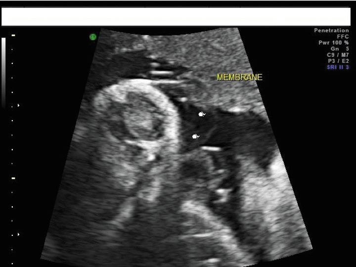 Ultrasound images: Fetal anomalies in multi-fetal gestations