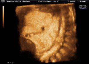 Fetal Abdomen with Gallbladder Calculi