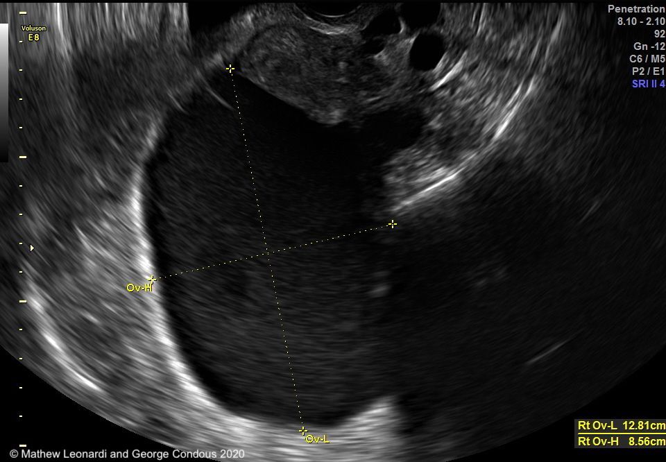 Noninvasive ultrasound diagnosis of endometriosis | Contemporary OB/GYN