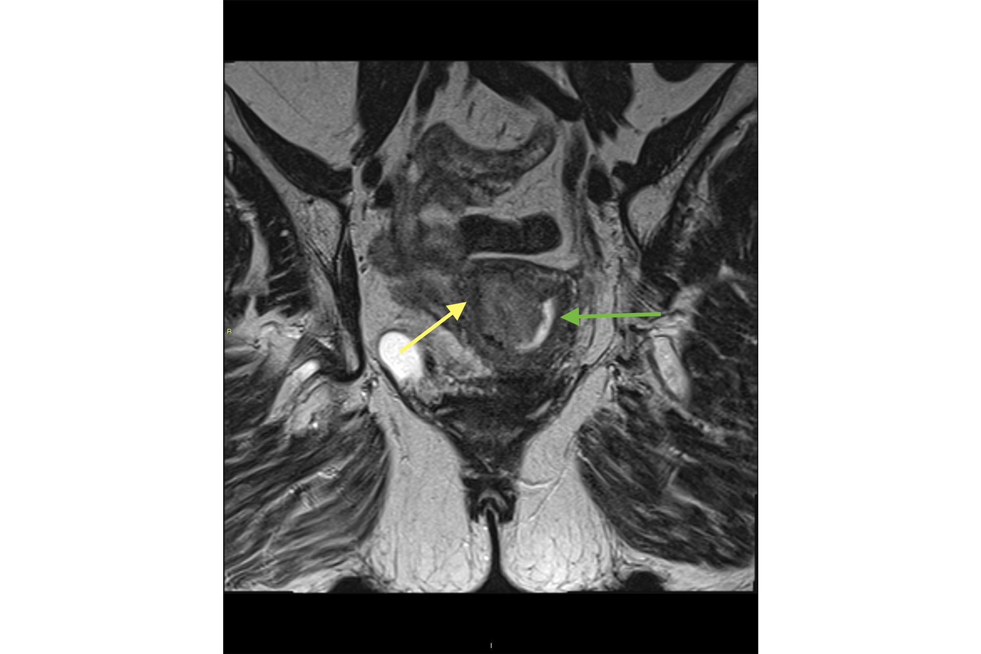 The value of GBCA in MRI images