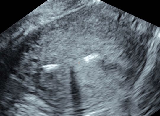 Ultrasound Image Iud Out Of Place