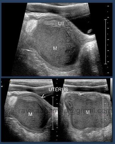 Daily Dx: A Child with Dysuria and Pelvic Pain