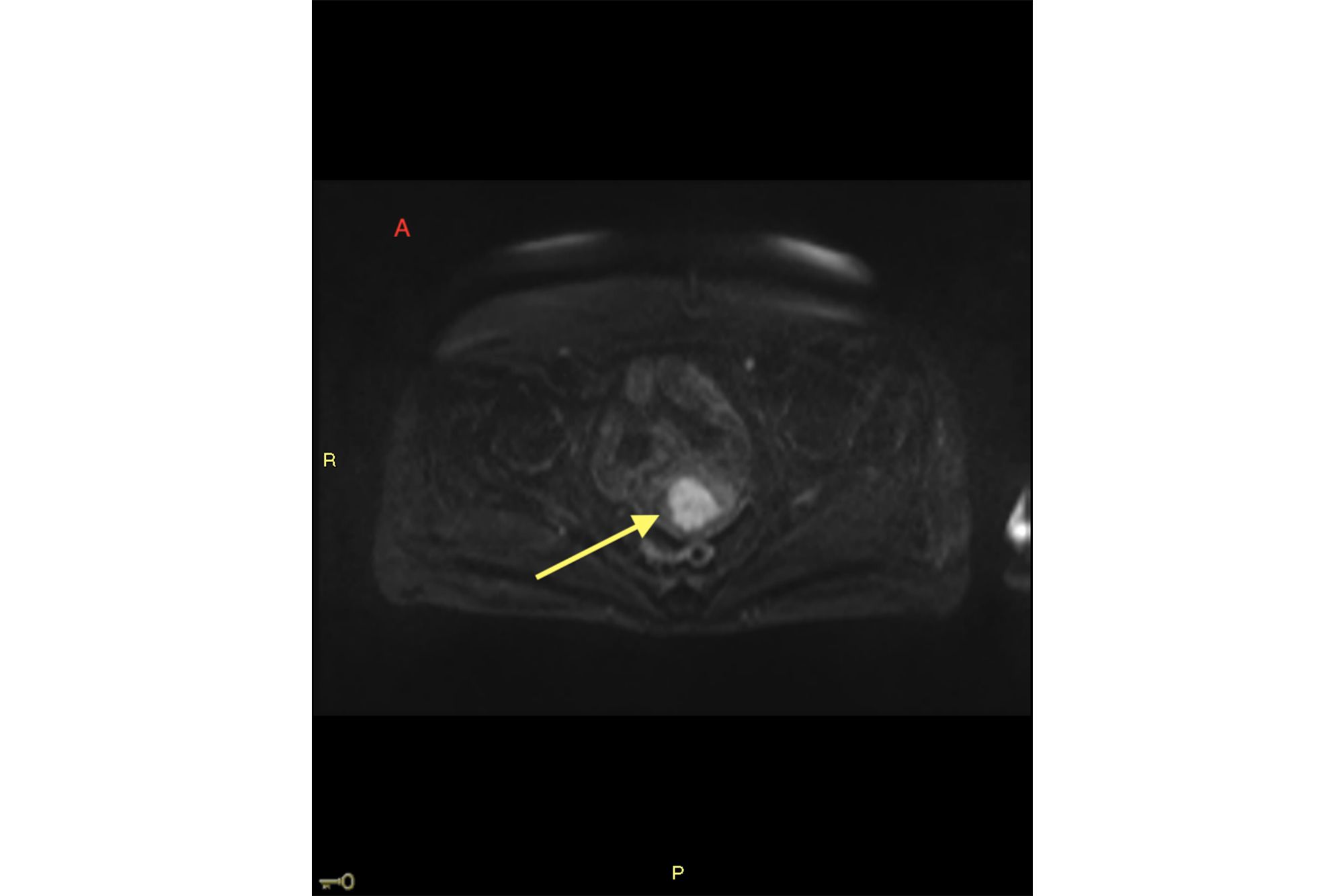 The value of GBCA in MRI images