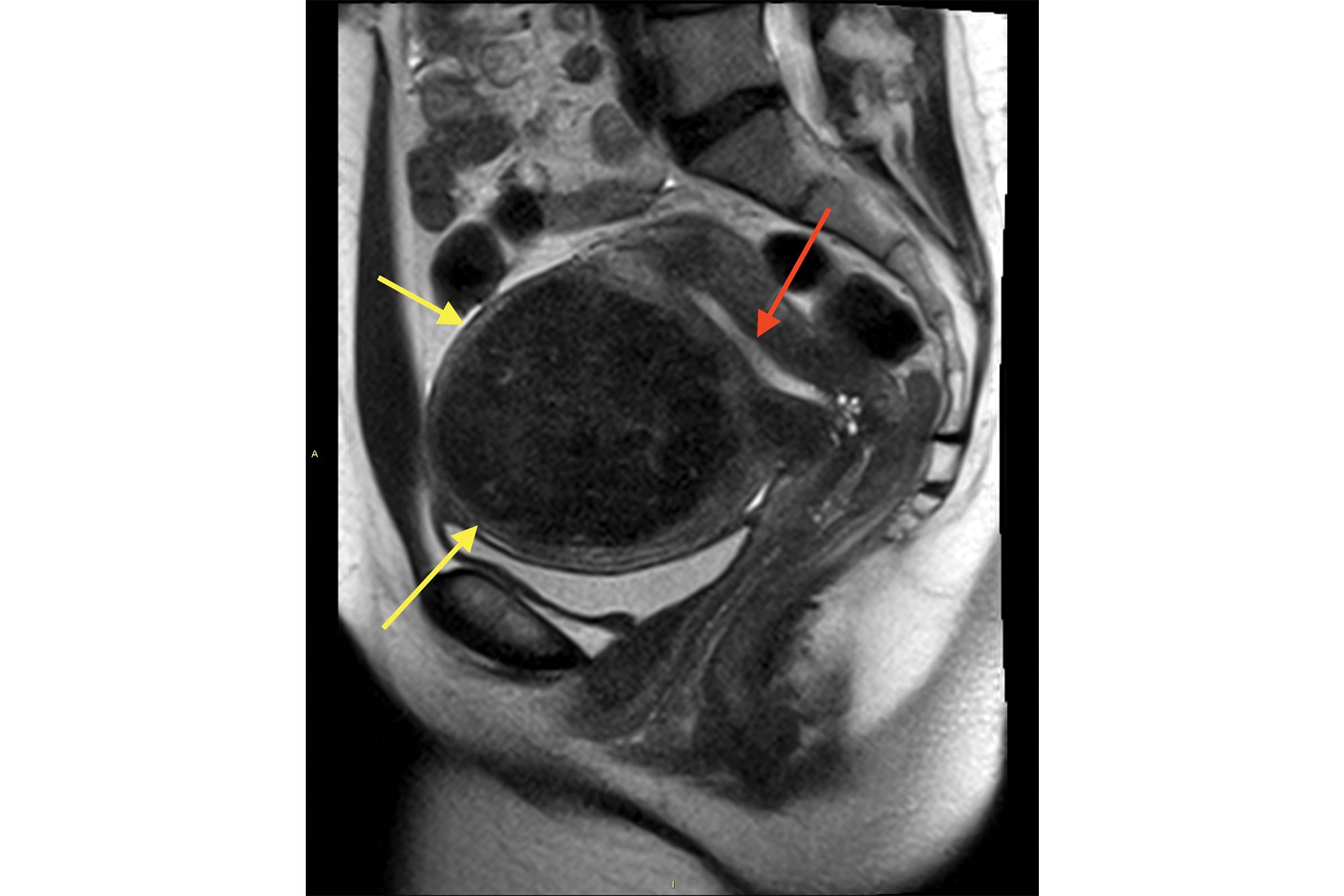The value of GBCA in MRI images | Contemporary OBGyn