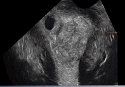 Diagnosis of Angular Pregnancy With 3D Ultrasound
