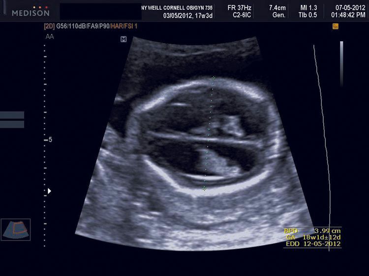 Ultrasounds images: Fetal anomalies of the first and second trimesters ...