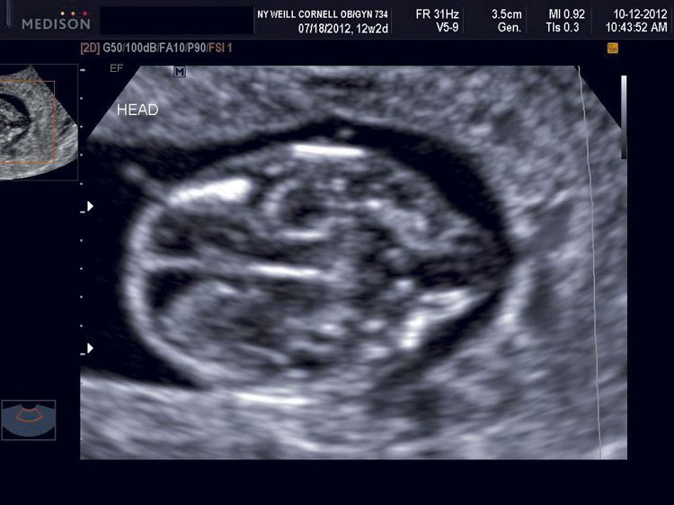 Ultrasounds images: Fetal anomalies of the first and second trimesters ...