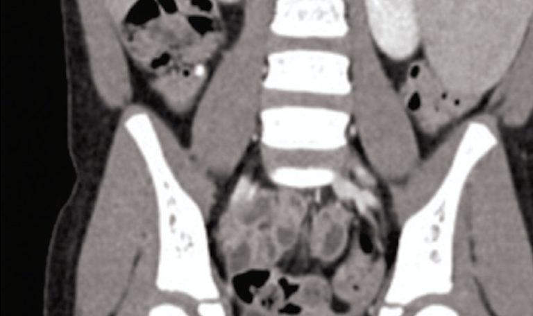 Massive splenomegaly in a 6-year-old girl
