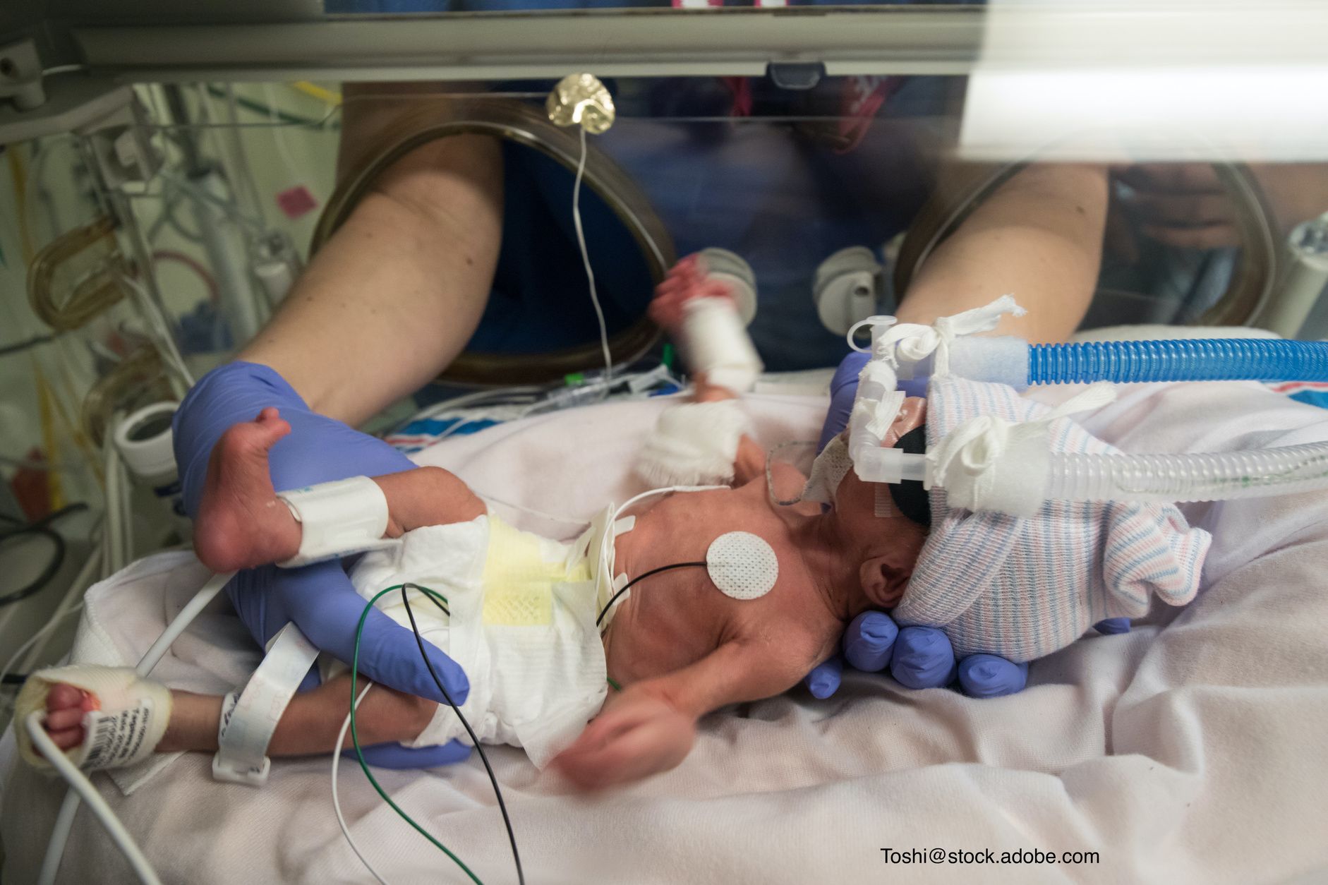 Examining the severity of bronchopulmonary dysplasia in very preterm ...